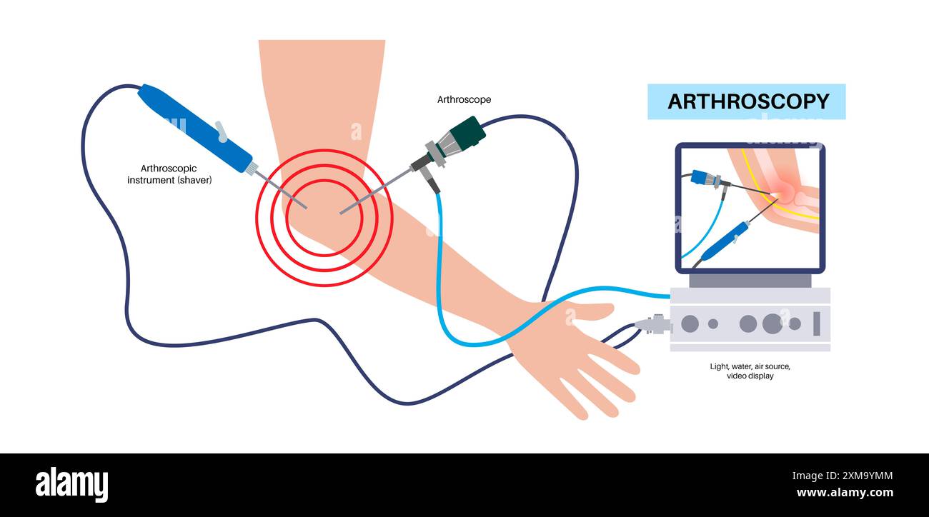 Illustration of elbow arthroscopy surgery. This is a procedure for ...
