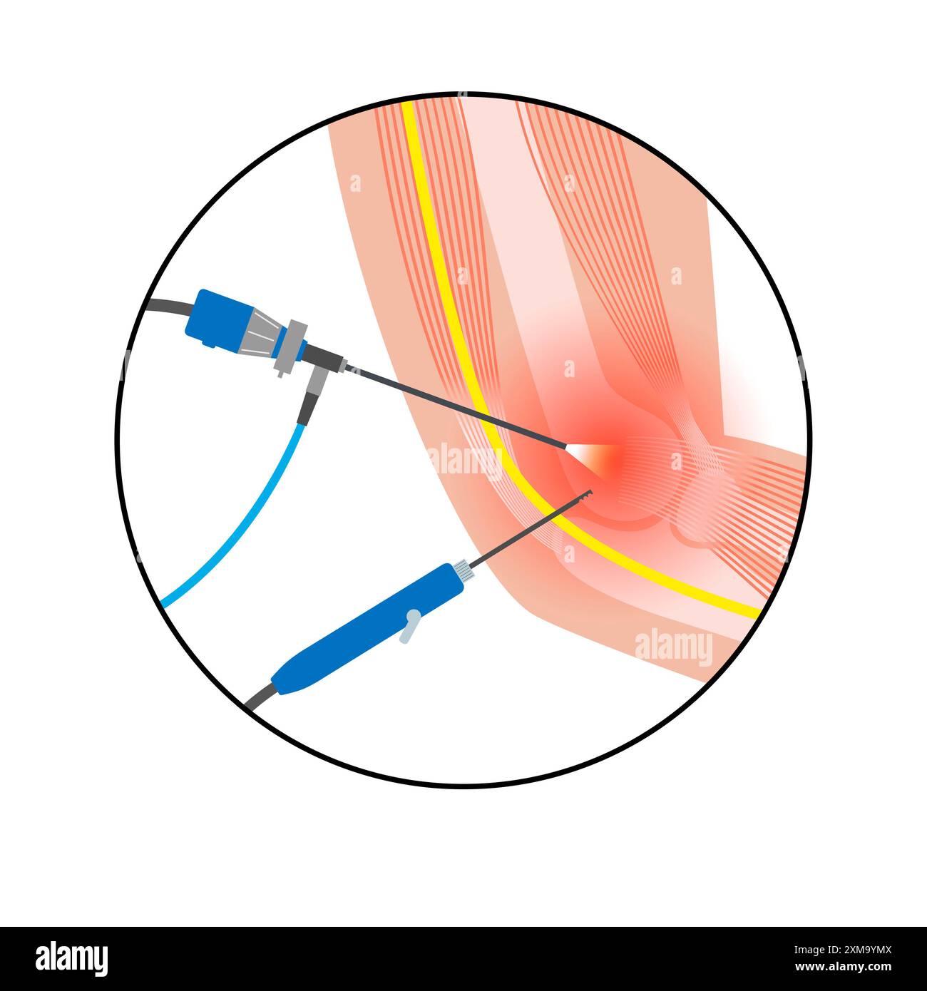 Illustration of elbow arthroscopy surgery. This is a procedure for ...