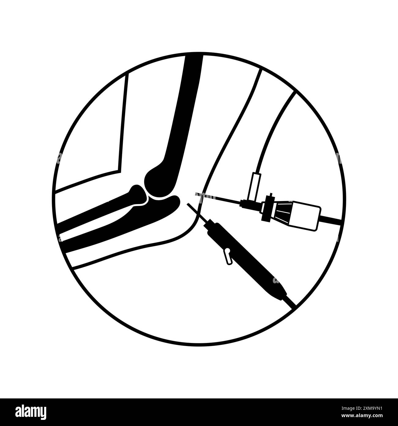 Illustration of elbow arthroscopy surgery. This is a procedure for ...