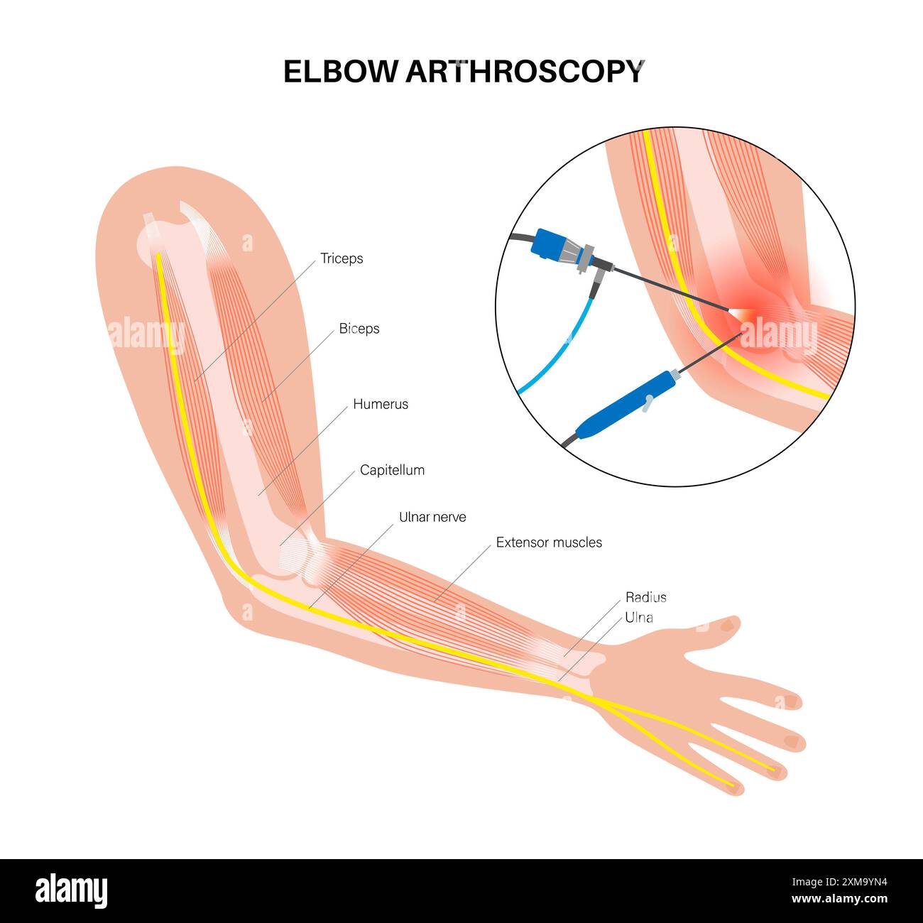 Elbow arthroscopy surgery hi-res stock photography and images - Alamy