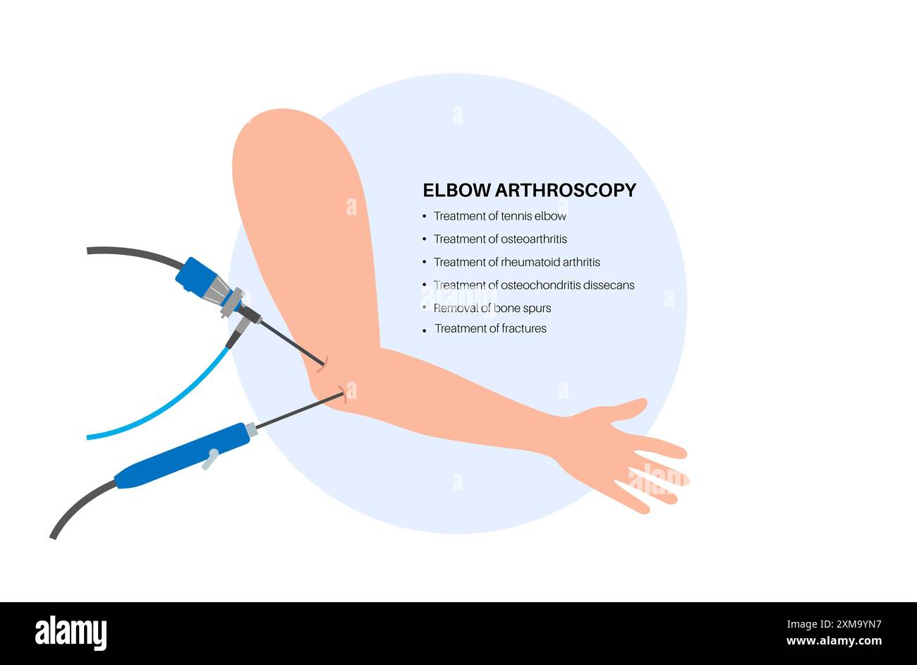 Illustration of elbow arthroscopy surgery. This is a procedure for ...
