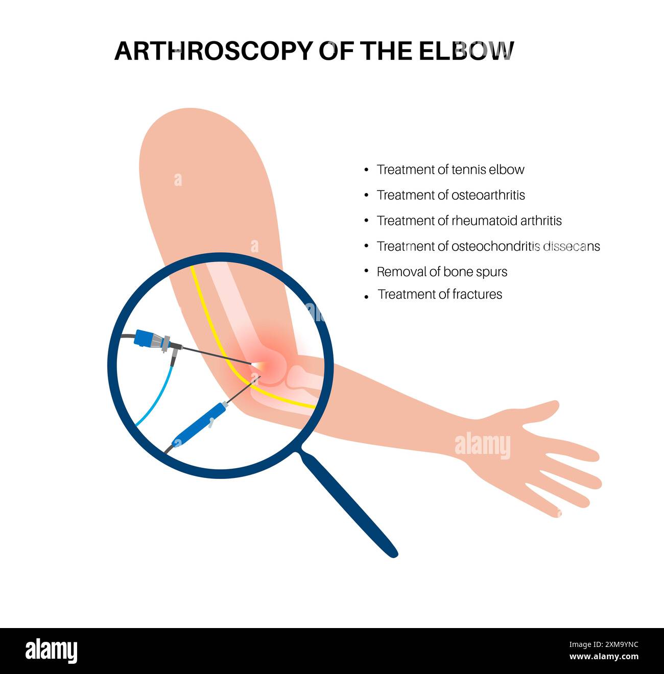 Illustration of elbow arthroscopy surgery. This is a procedure for ...