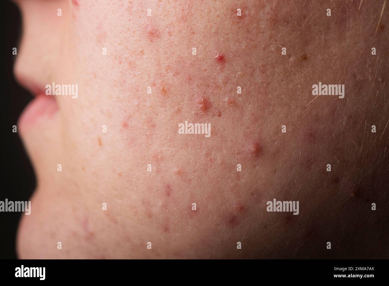 Pimple on face. Skin texture. Closeup acne skin. Treatment for skin ...