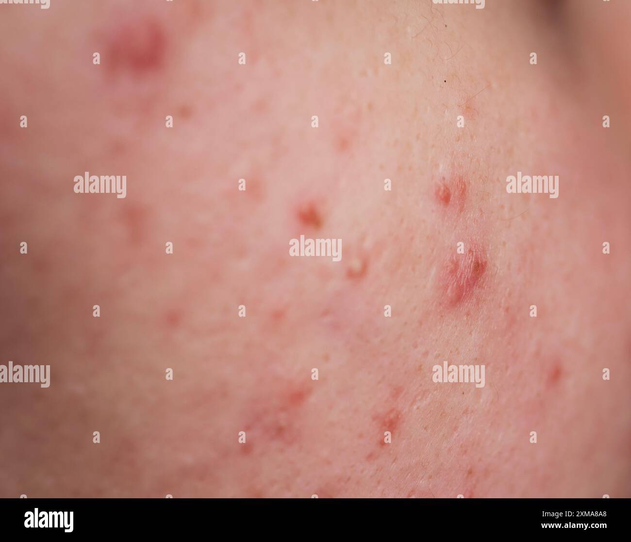 Skin texture background. Closeup acne pimple. Treatment for skin ...