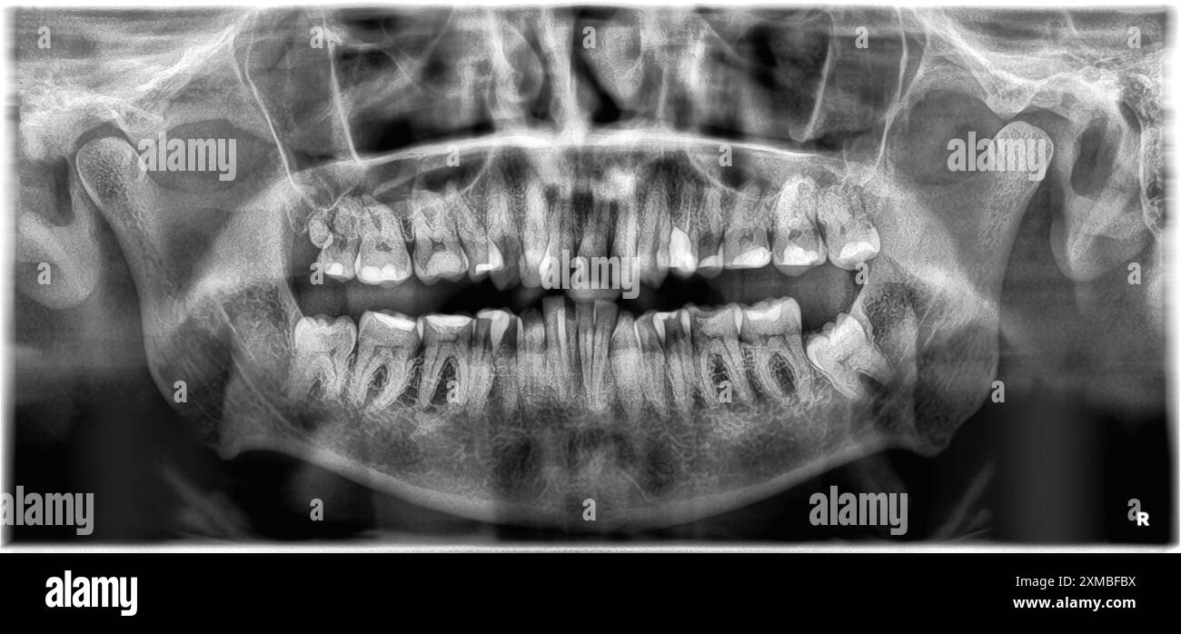 Panoramic Dental X-ray picture - 35 years old male have fourth molar on ...