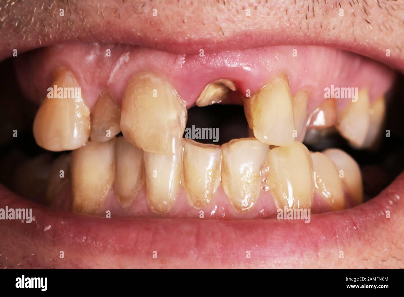 Crooked teeth in the mouth. Orthodontics. Malocclusion. Dental disease ...