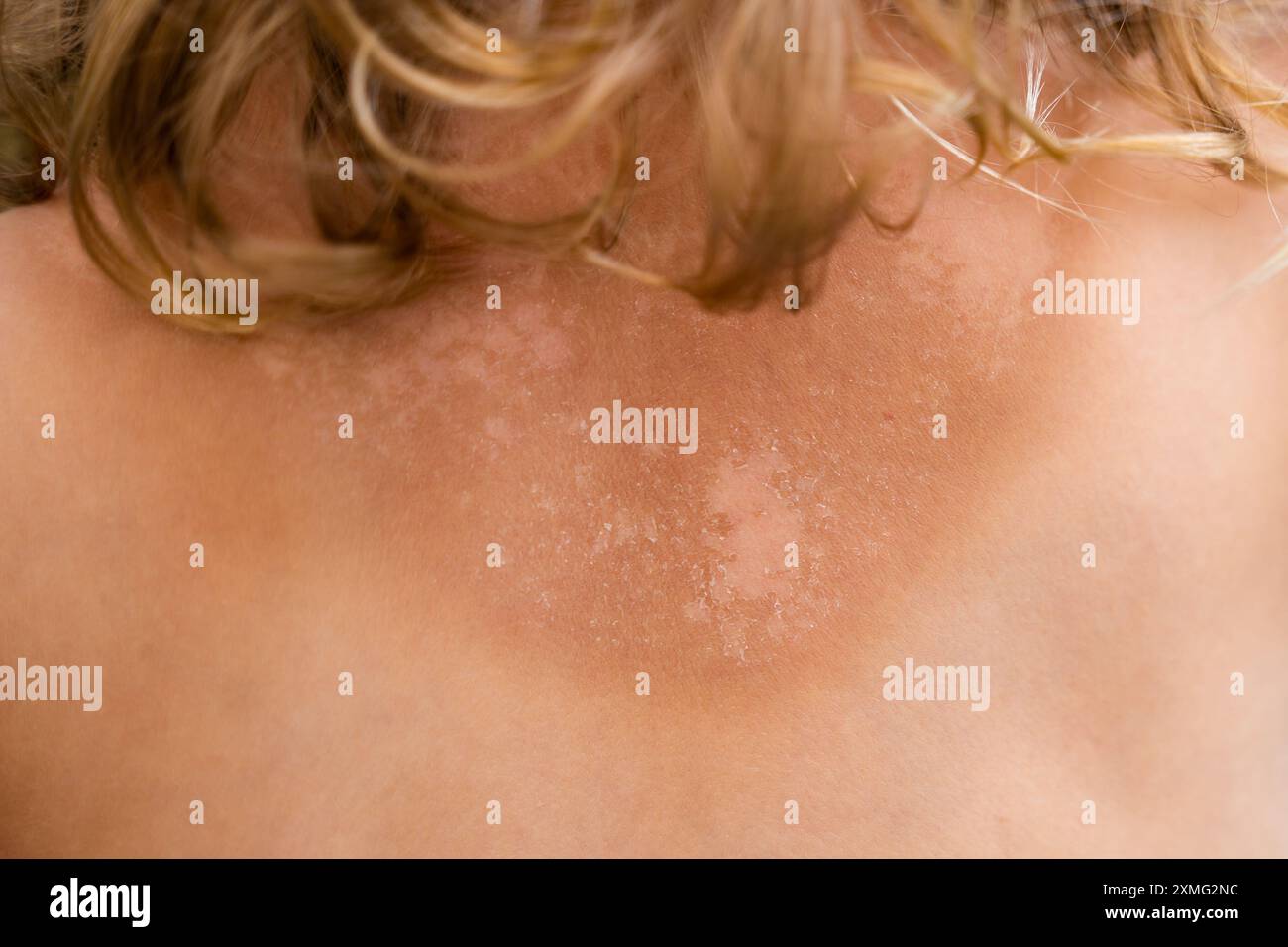 The skin is very peeling after sunbathing, the tanned back of a little ...