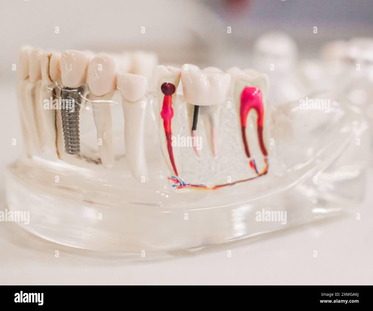 Human jaw teeth implants hi-res stock photography and images - Alamy
