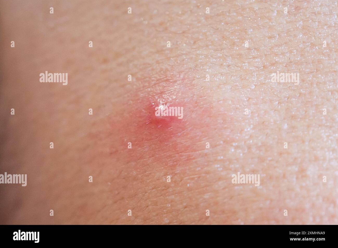 Inflammatory acne with red spot on face closeup Stock Photo - Alamy