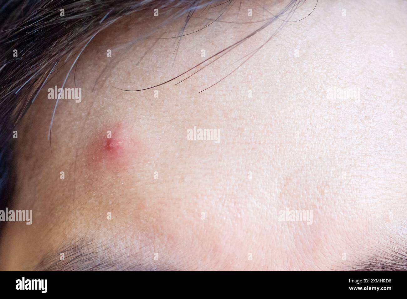 Inflammatory acne with red spot on face closeup Stock Photo - Alamy