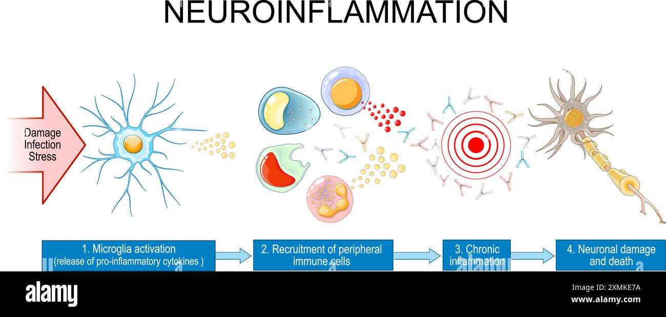 Neuroinflammation. Development of Neurodegenerative Diseases. From injury of brain, damage ...