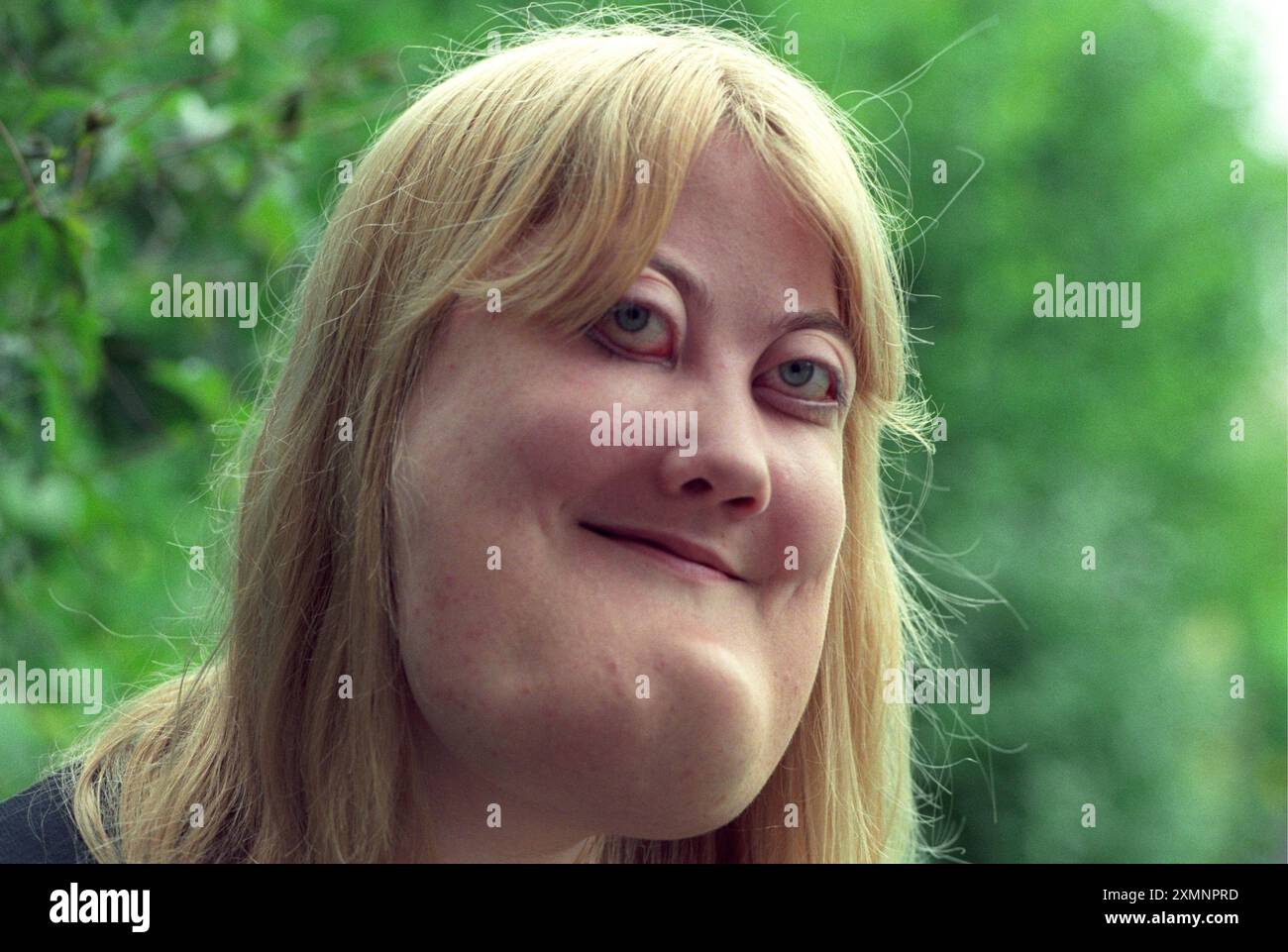 A young woman with cherubism. The rare genetic condition is a ...