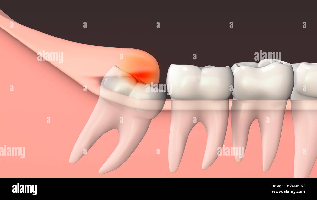 Inflammation of the gums due to an unerupted molar Stock Photo - Alamy