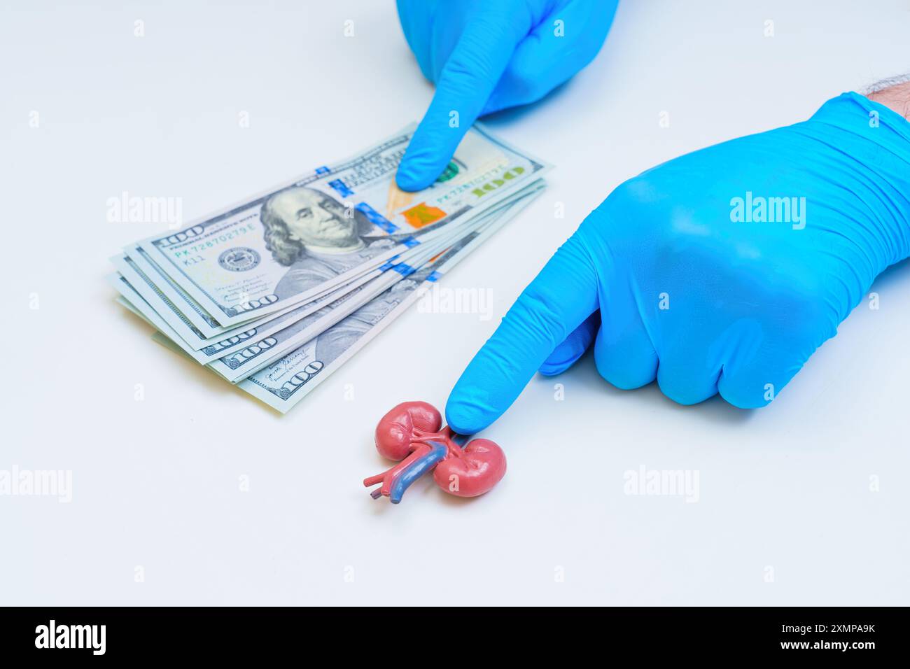 Hands in blue gloves exchanging a kidney model for a stacks of cash ...