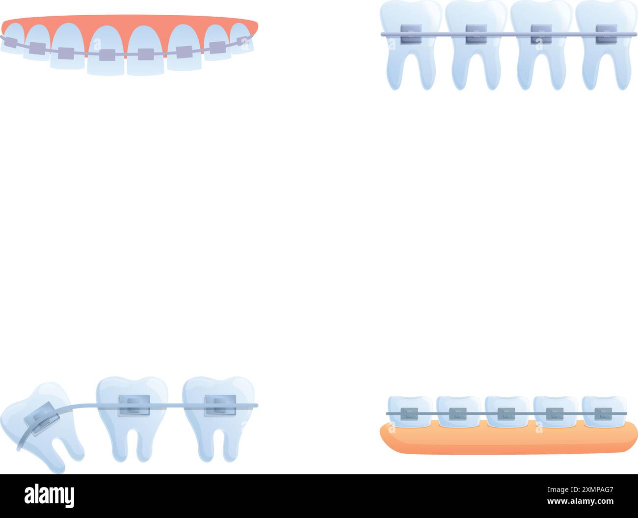 Bite correction icons set cartoon vector. Orthodontic brace system on teeth. Orthodontic ...
