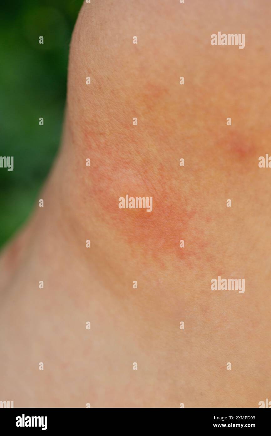 Inflamed human skin after a mosquito bite Stock Photo - Alamy