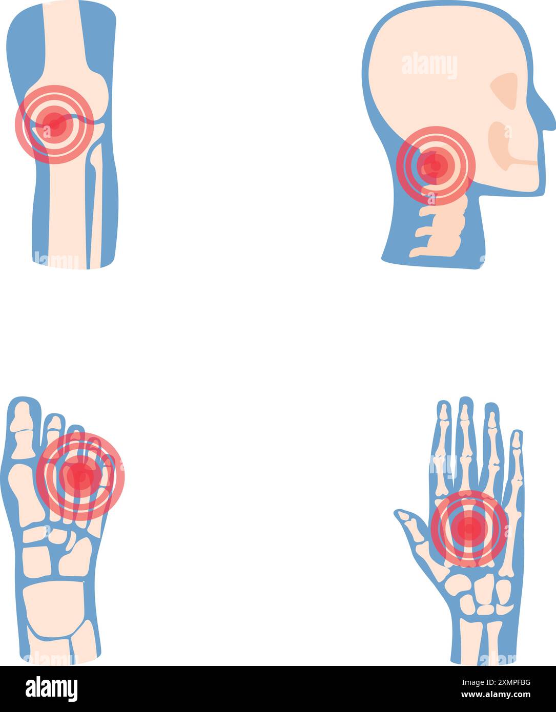 Swollen joint Cut Out Stock Images & Pictures - Alamy