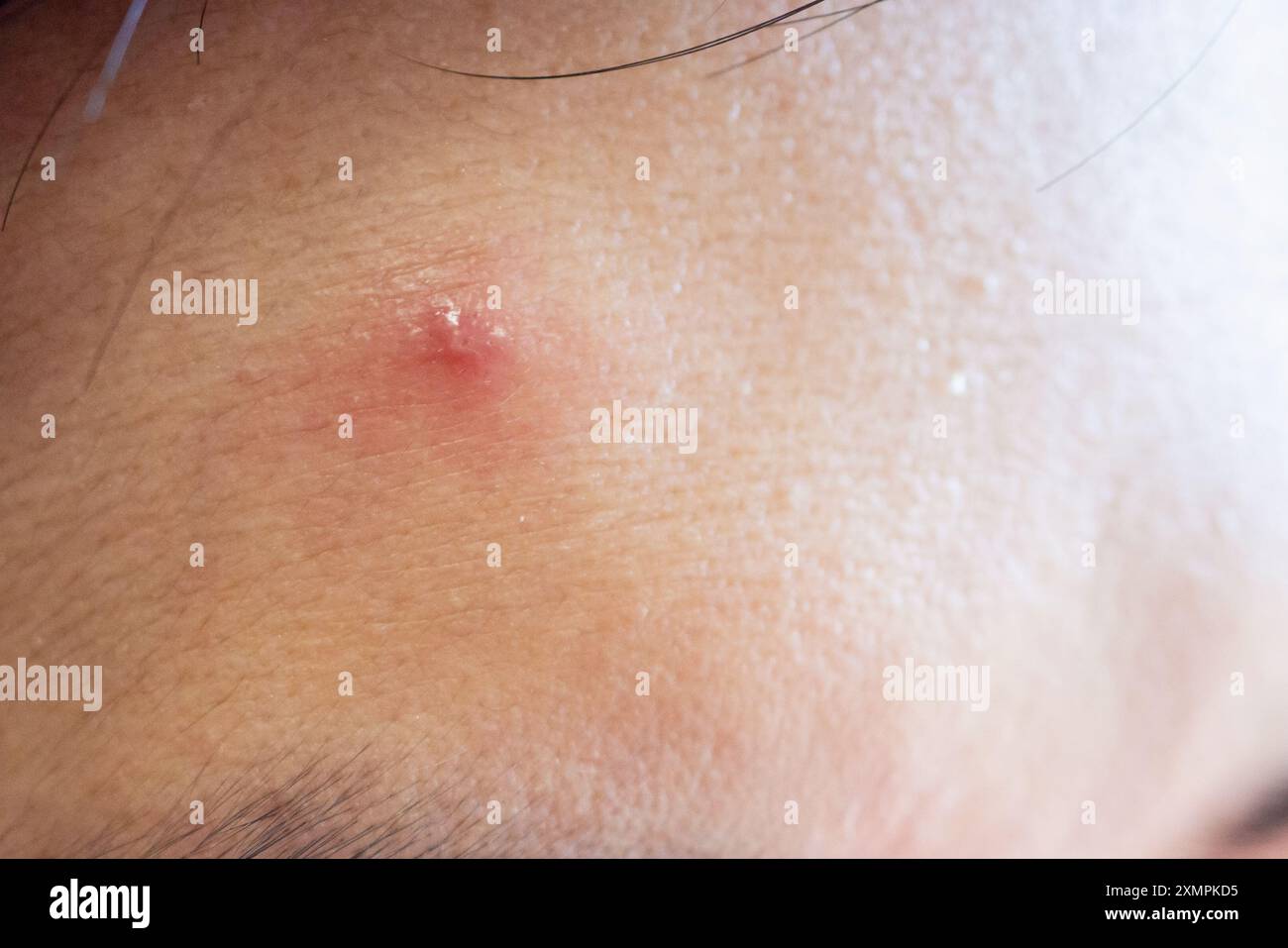 Cystic acne on face hi-res stock photography and images - Alamy
