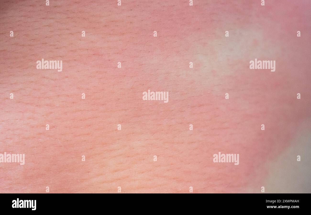 Severe eczema skin rash and allergic reaction symtom at little asian ...