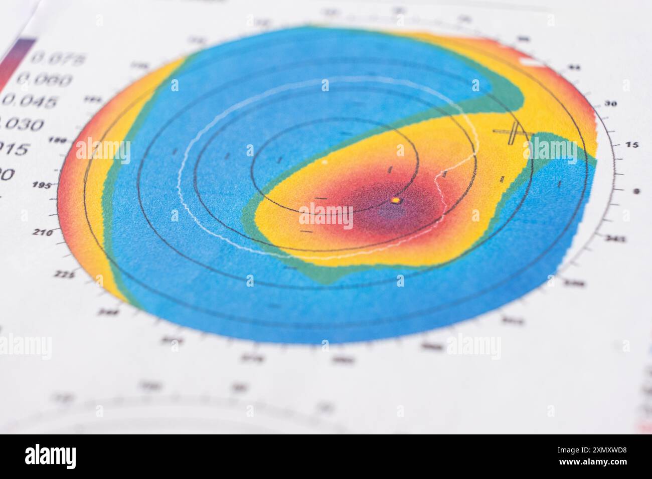 Results of the examination of the thickness and curvature of the cornea ...