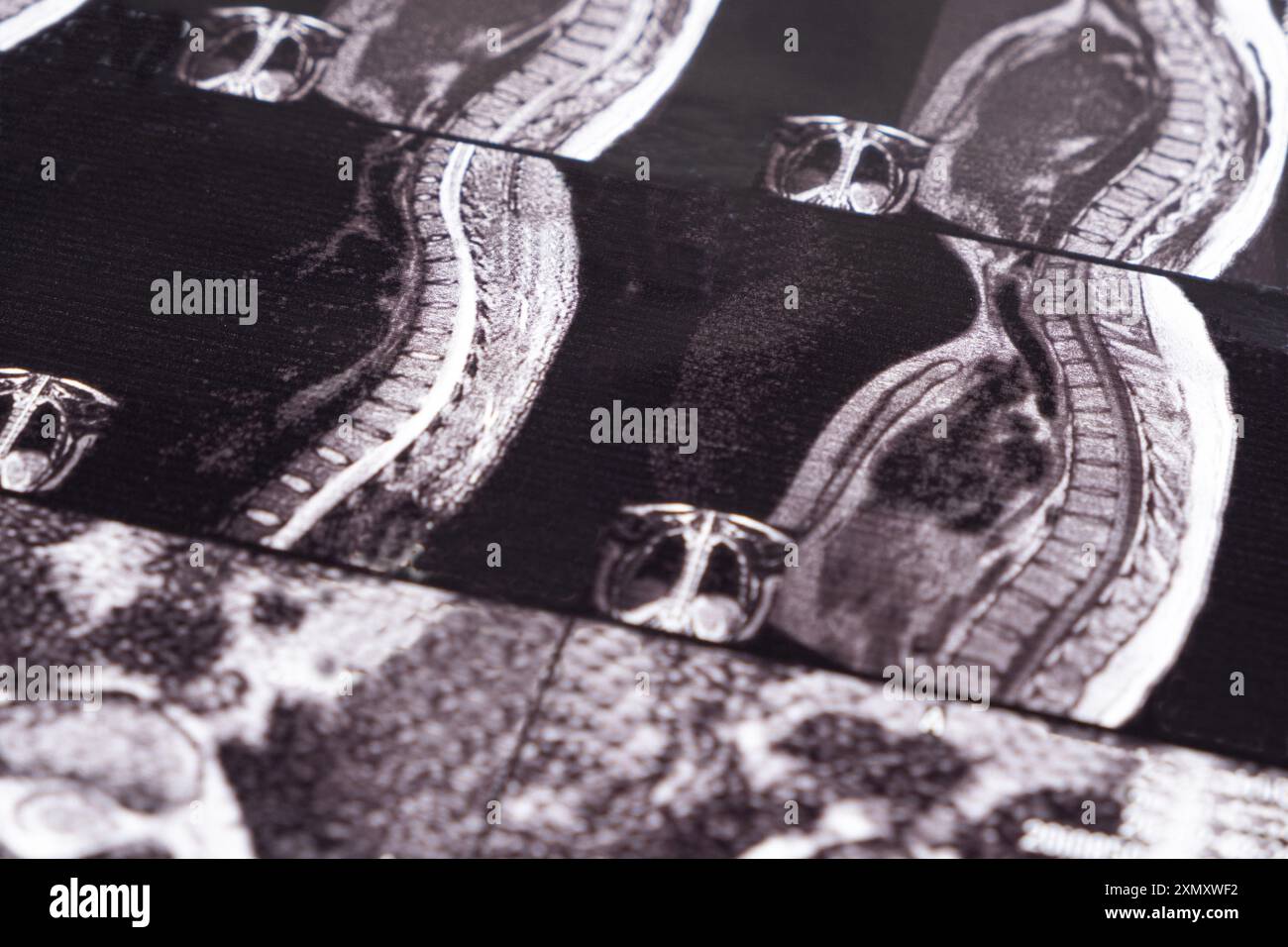 MRI of a patient with intervertebral disc protrusion and ...