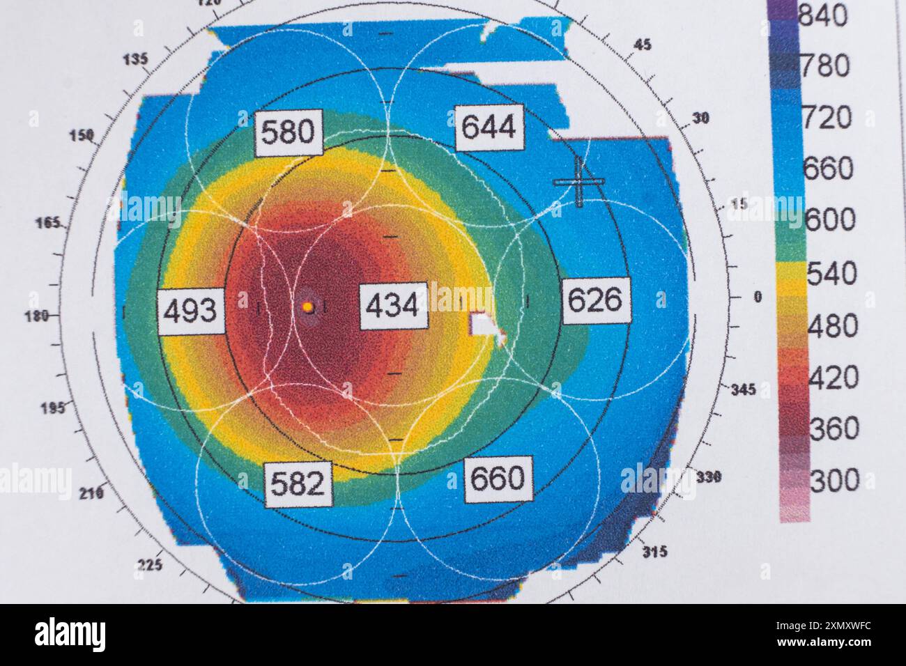 Results of the examination of the thickness and curvature of the cornea ...