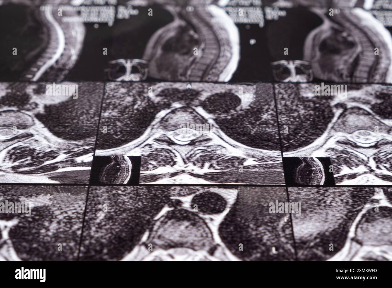 MRI of a patient with intervertebral disc protrusion and ...