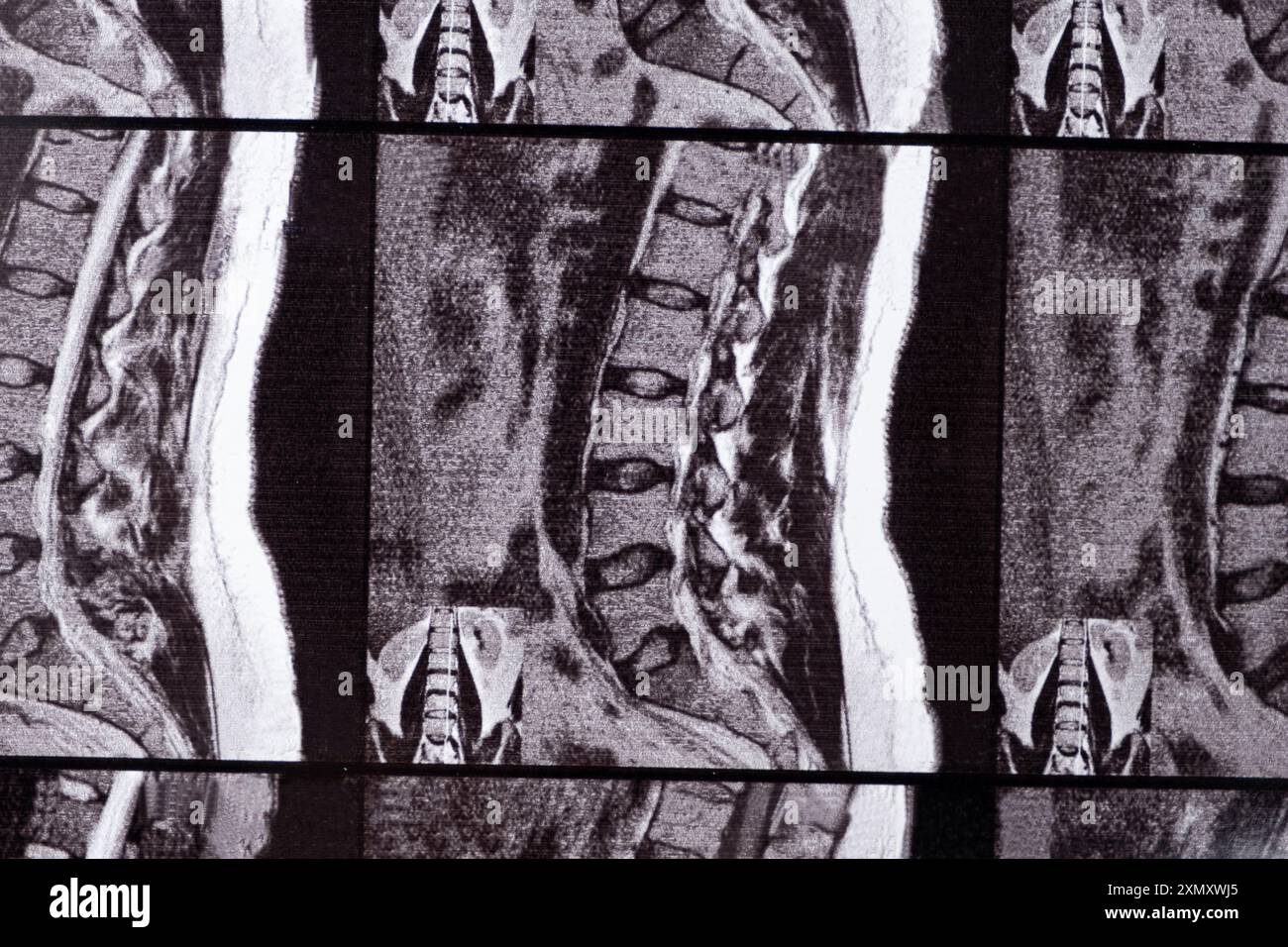 MRI of a patient with intervertebral disc protrusion and ...