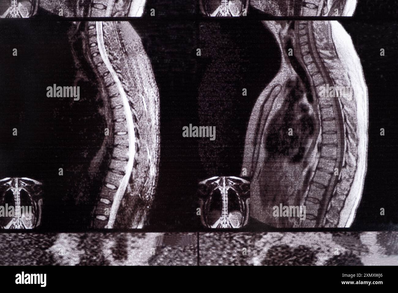 MRI of a patient with intervertebral disc protrusion and ...