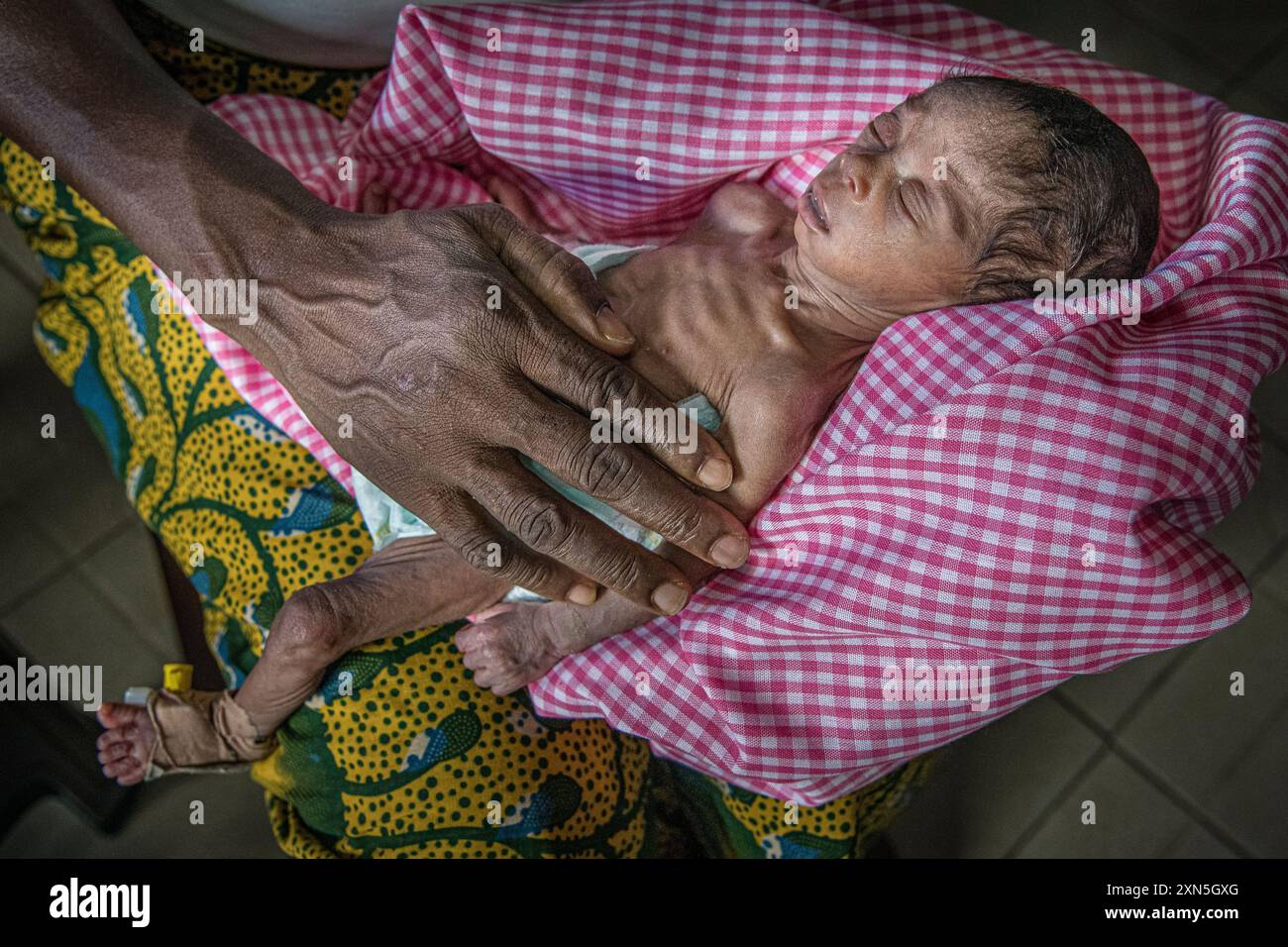 Premature baby boy 17 days after birth. This baby was born at 31 weeks ...