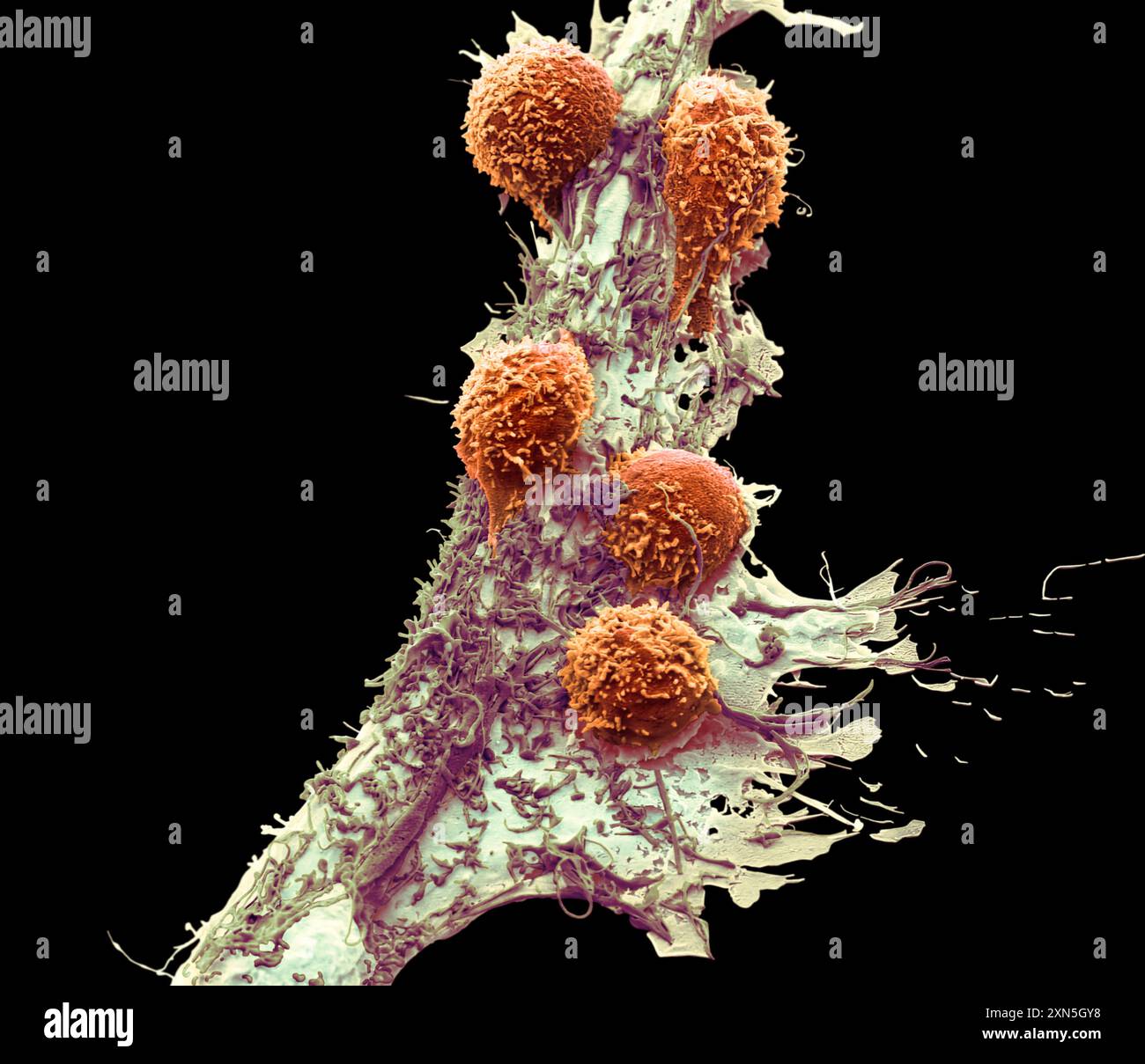 Hela cancer cell and T cells. Coloured scanning electron micrograph ...
