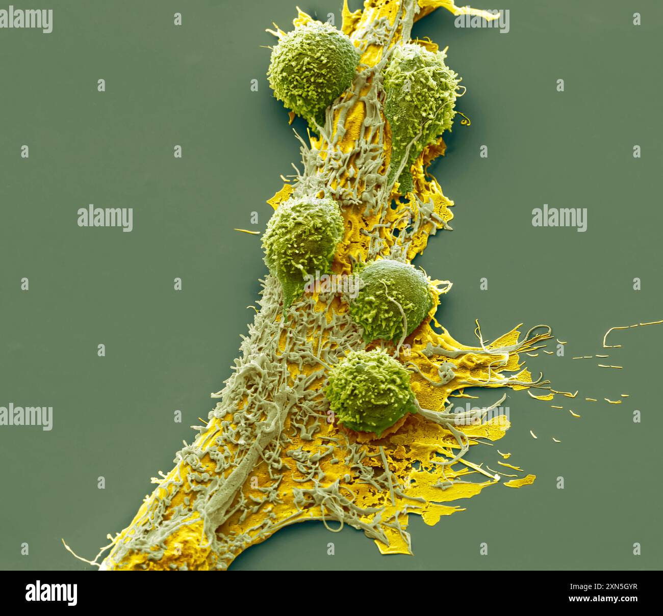 Hela cancer cell and T cells. Coloured scanning electron micrograph ...