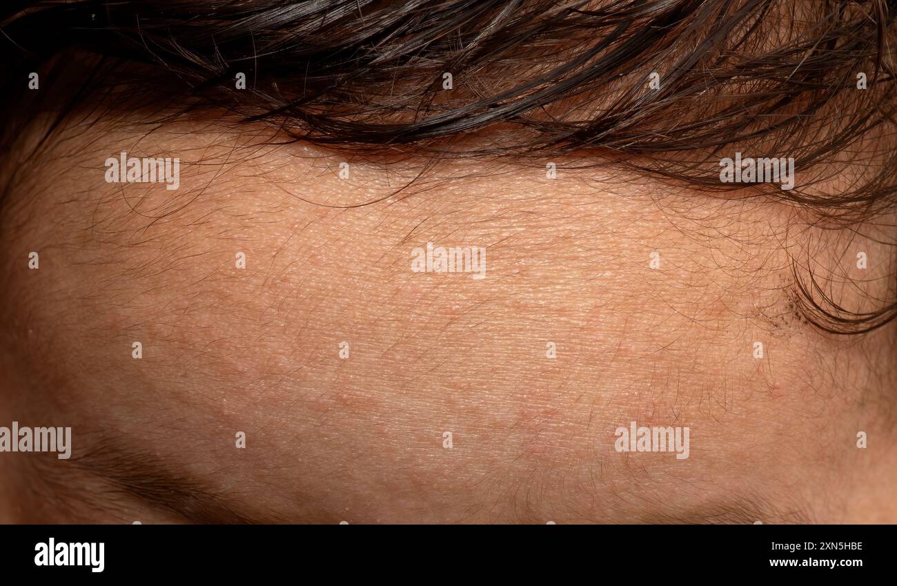 Milia on forehead of a female toddler. Milia are small keratin-filled ...