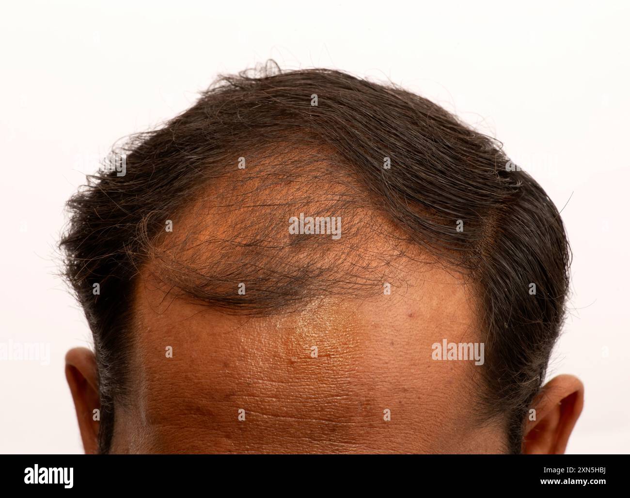 Male pattern baldness. Also known as male androgenic alopecia, this is the most common form of ...