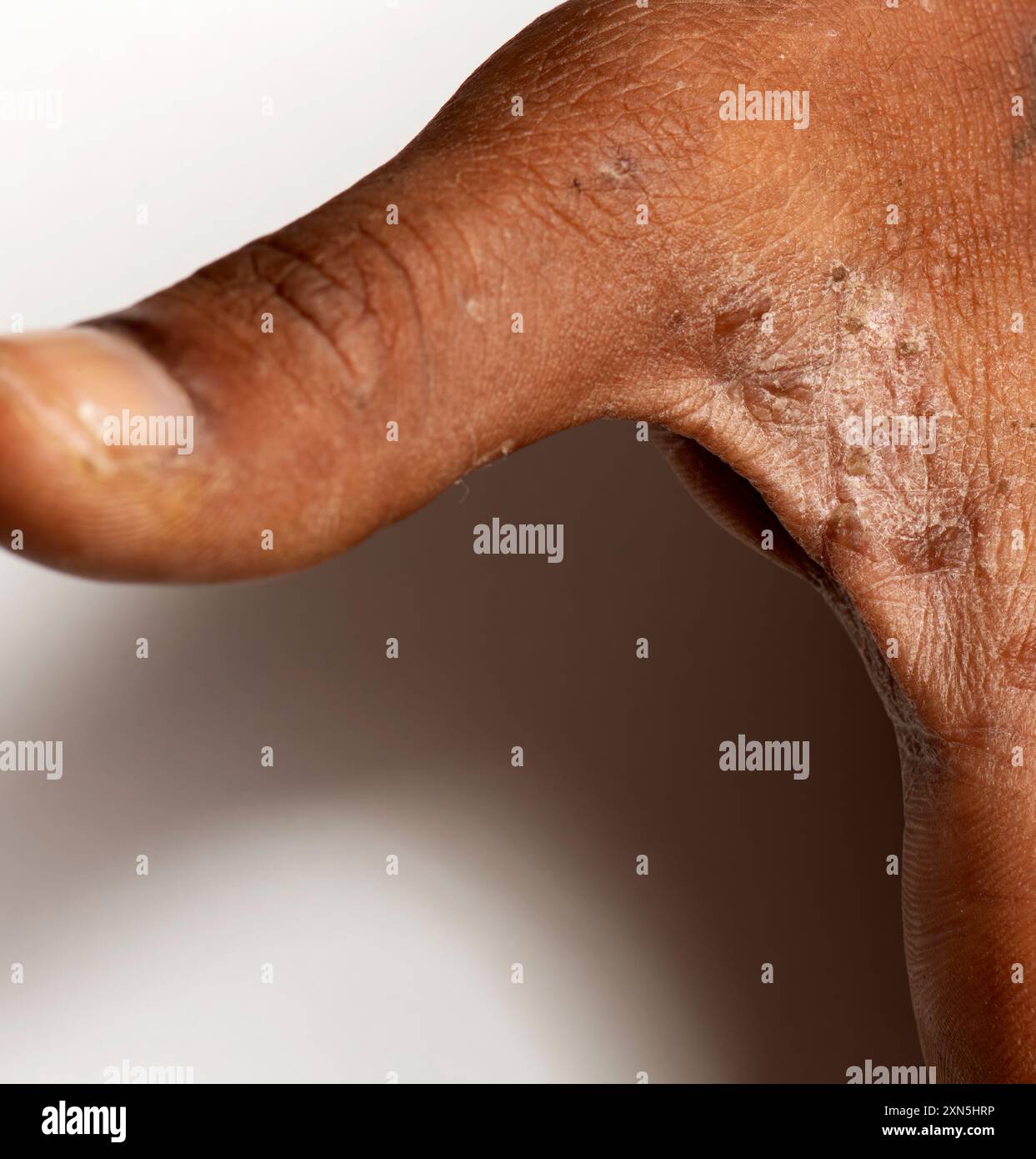 Hand of a boy infected with scabies. Scabies is caused by the mite ...