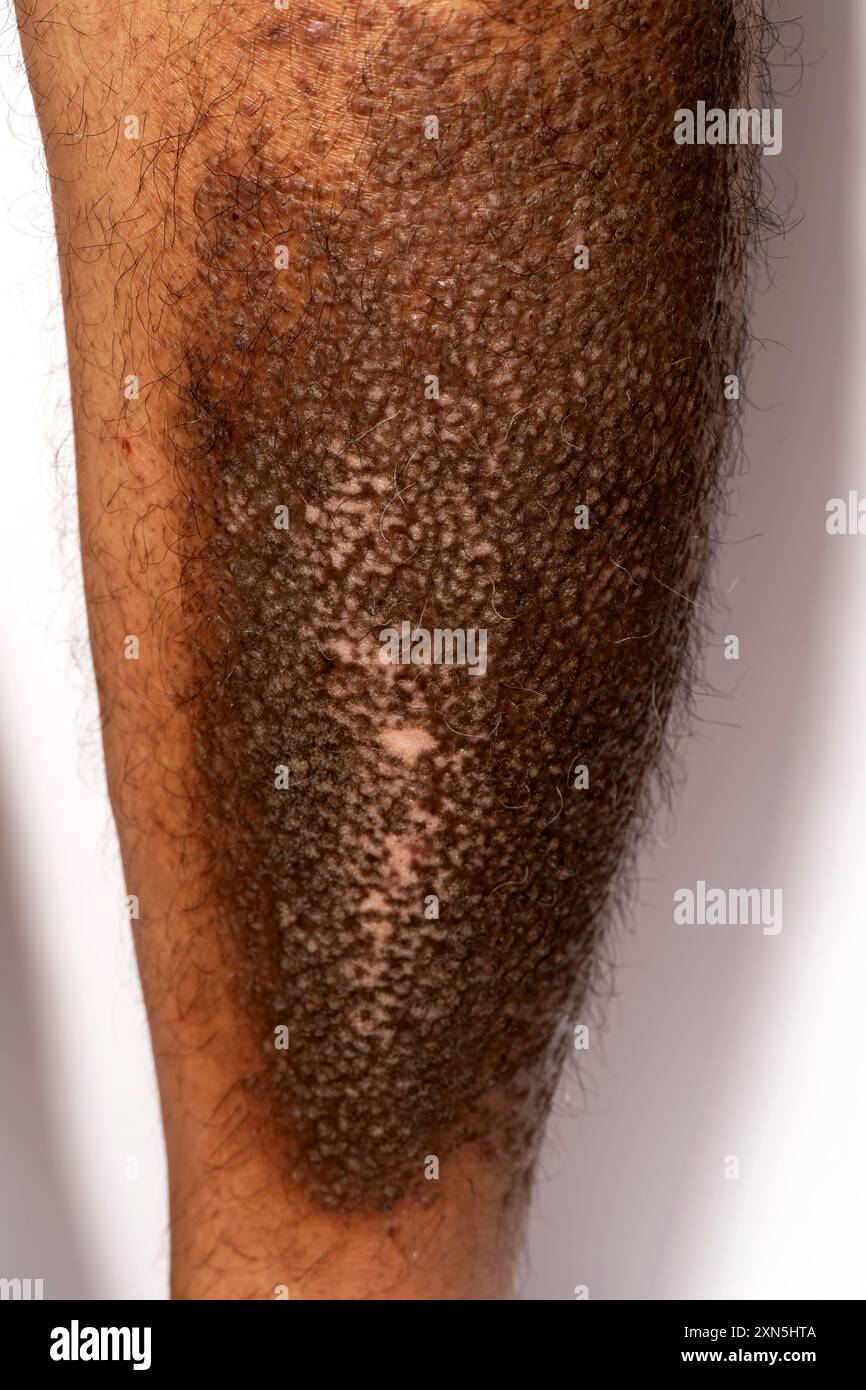 Cutaneous amyloidosis on a male patient's shin. This is a disease where ...
