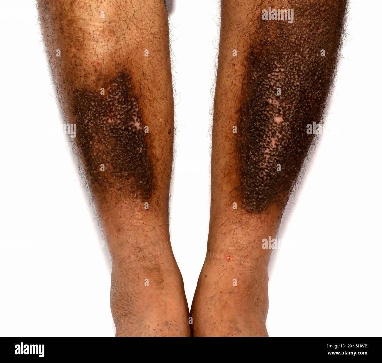 Cutaneous amyloidosis on a male patient's shin. This is a disease where ...