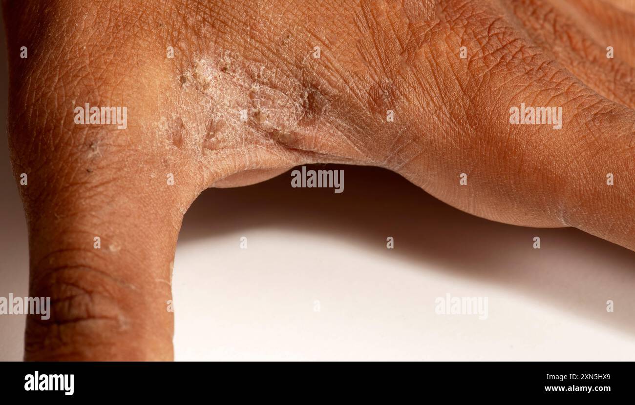 Hand of a boy infected with scabies. Scabies is caused by the mite ...