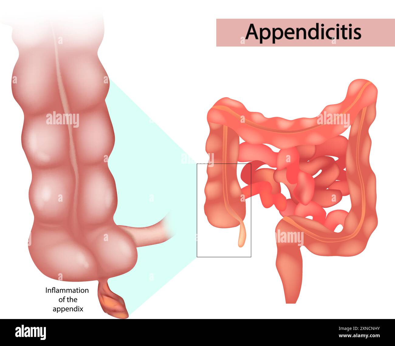 Appendicitis operation Stock Vector Images - Alamy