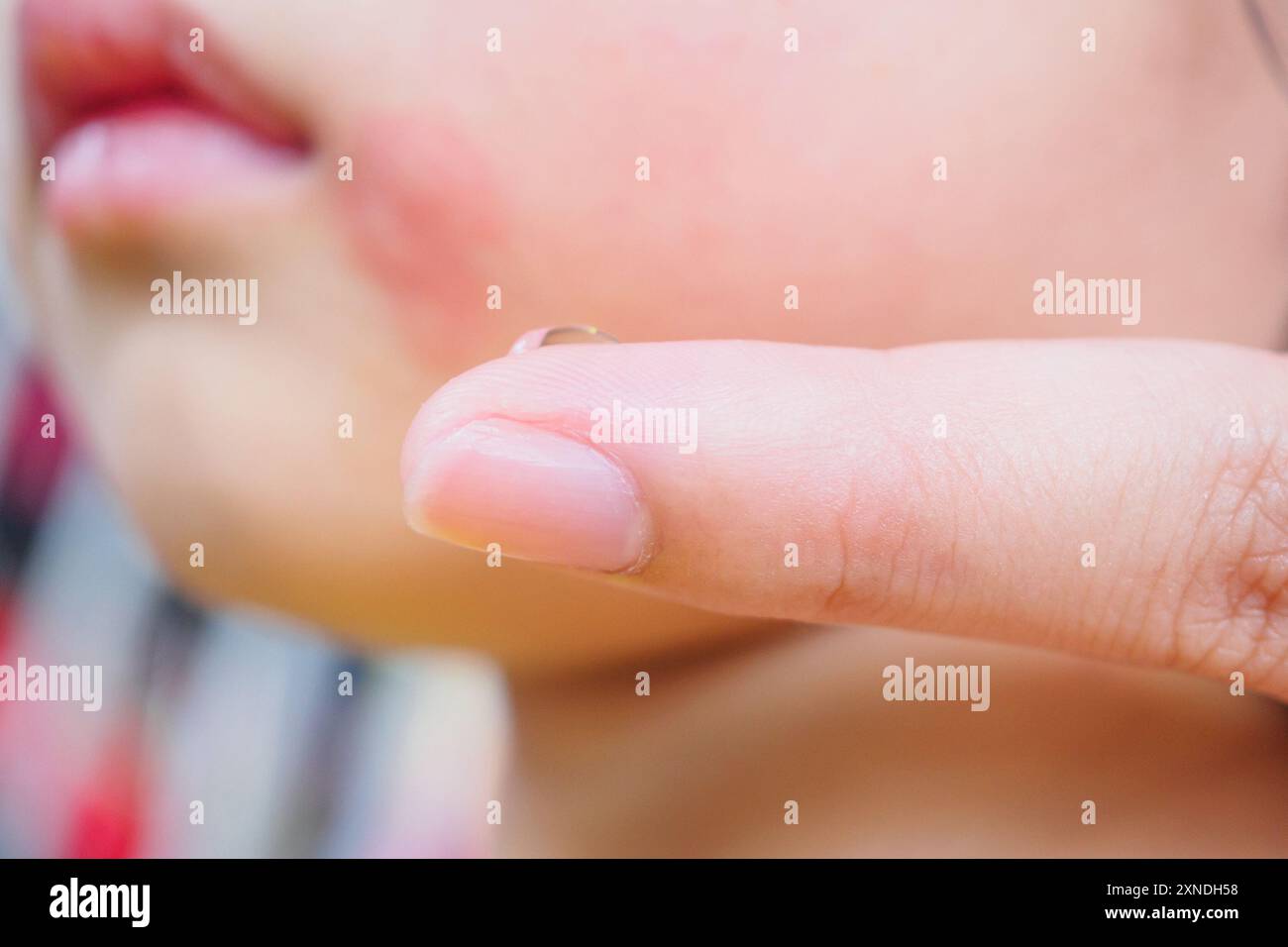 Hand applying topical antihistamine medicine hi-res stock photography ...