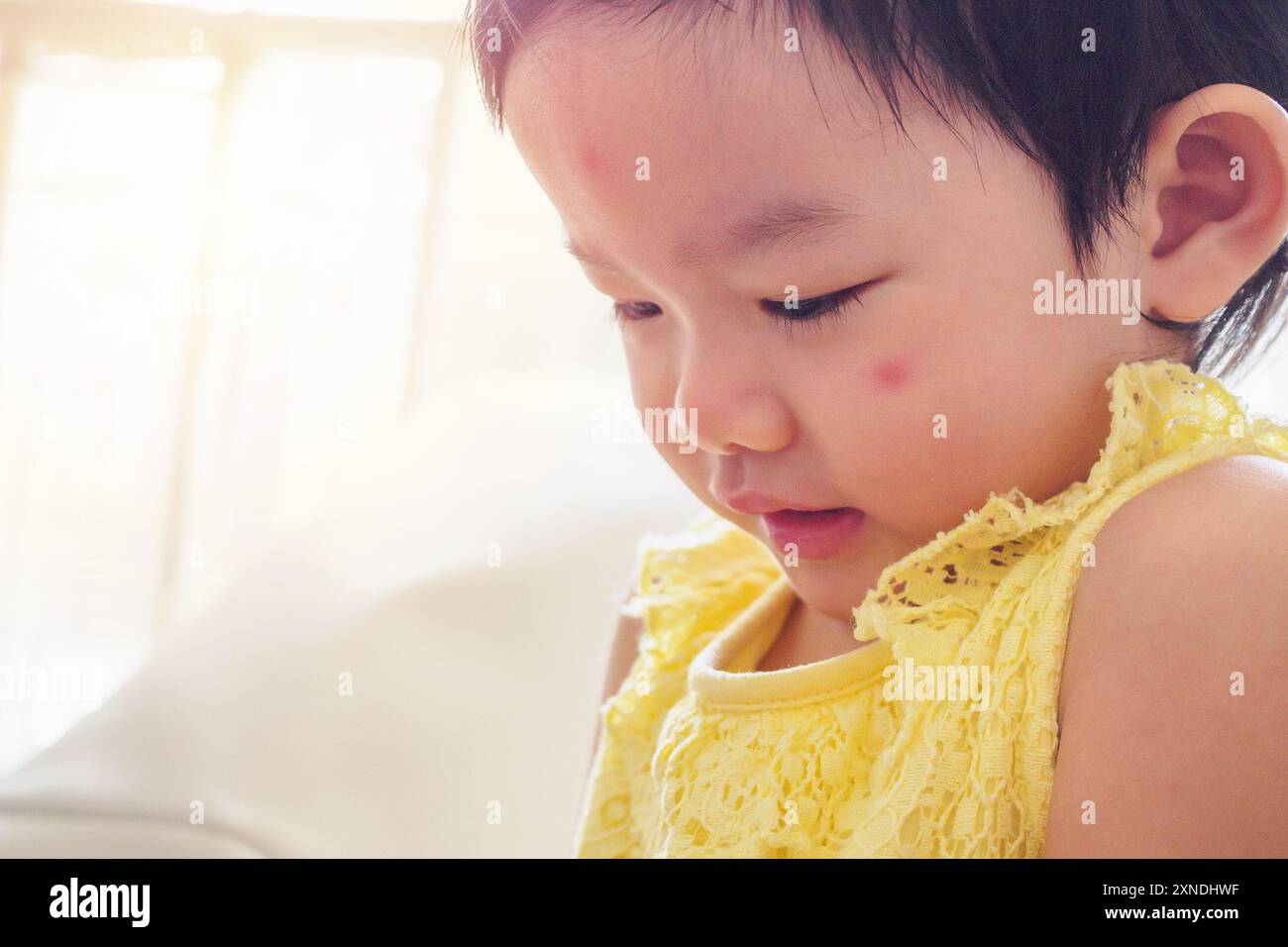 Cute little asian girl with allergy red spot face cause by insect bite ...