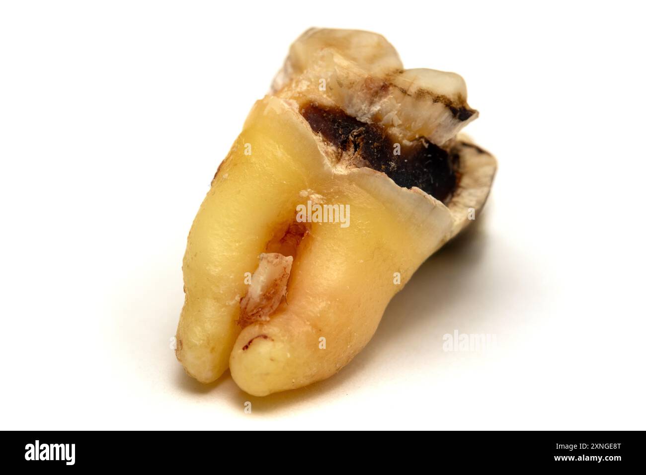 Removed wisdom tooth with caries isolated on a white background, close ...
