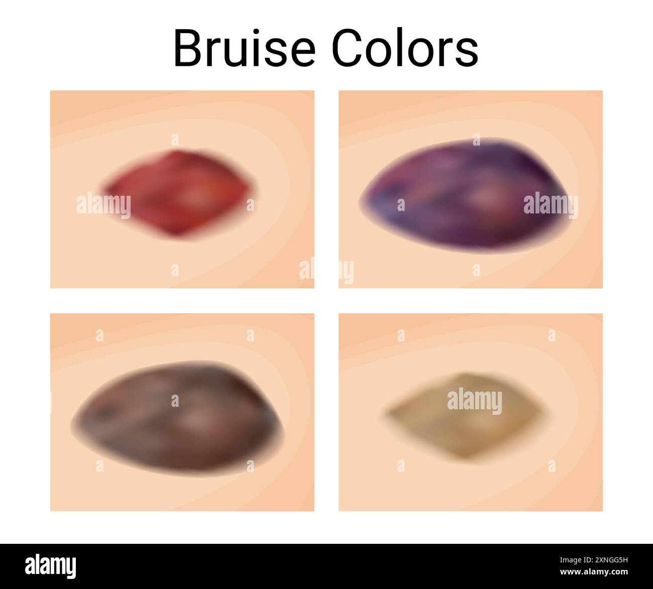 Healing Stages of Bruises and Hematomas Stock Vector Image & Art - Alamy