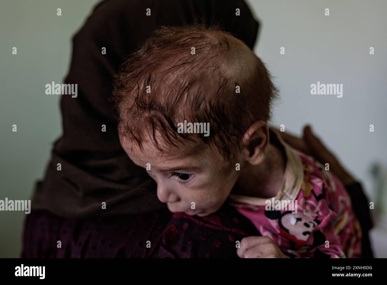 25 July 2024, Syria, Atimah: Baby Marwan Shahen, 7 months, suffers from ...