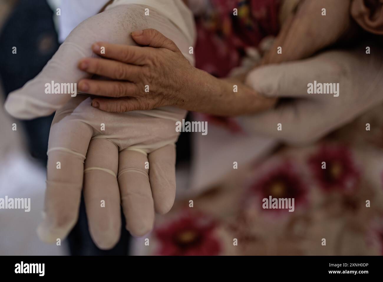 25 July 2024, Syria, Atimah: Baby Marwan Shahen, 7 months old, suffers ...