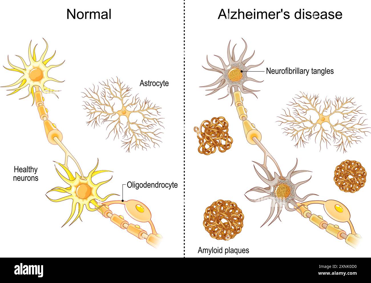 Alzheimer's disease. Comparison of neurons in a healthy brain and nerve cells in ...