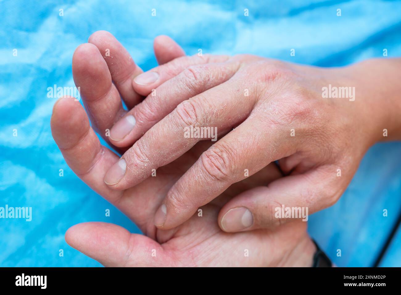 Close-up of hands with very bad skin condition, cracked skin on hands ...