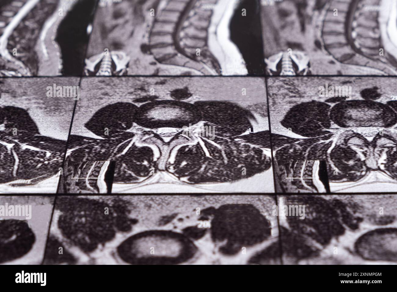 MRI of a patient with intervertebral disc protrusion and ...
