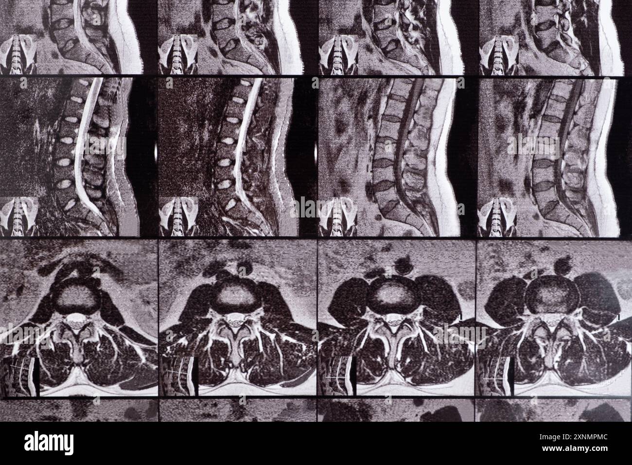 MRI of a patient with intervertebral disc protrusion and ...