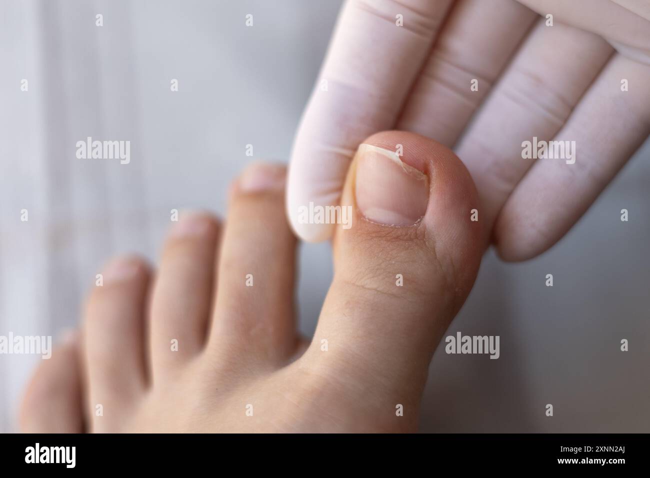 Close-up of broken and injured big toe nail Stock Photo - Alamy